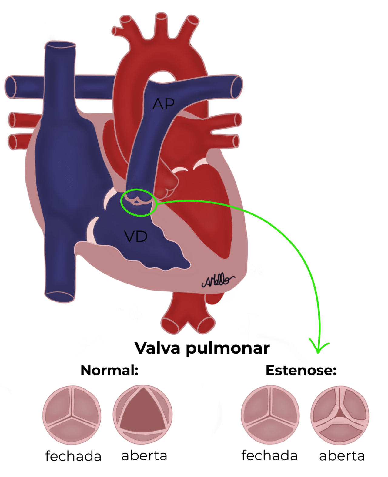 Eco De Estenose Valvar Pulmonar Стеноз АоКл